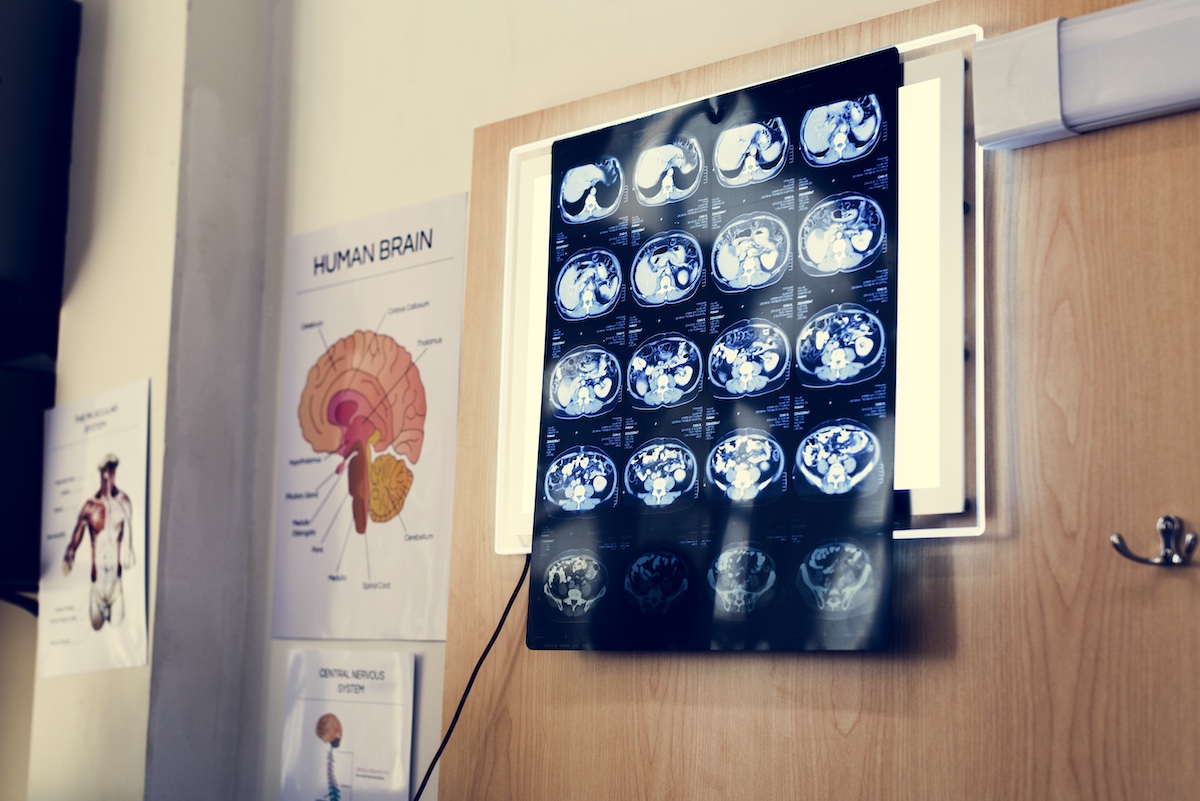 How Does PTSD Affect the Brain | Evolve Counseling Services
